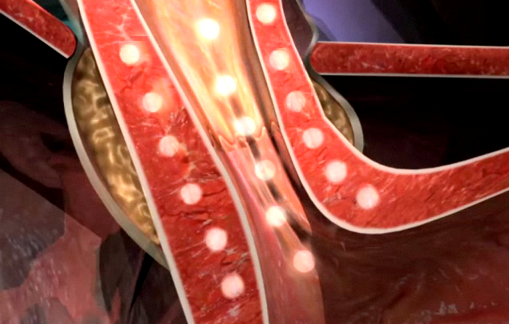 STRETTA – Pioneira no tratamento de refluxo gástrico